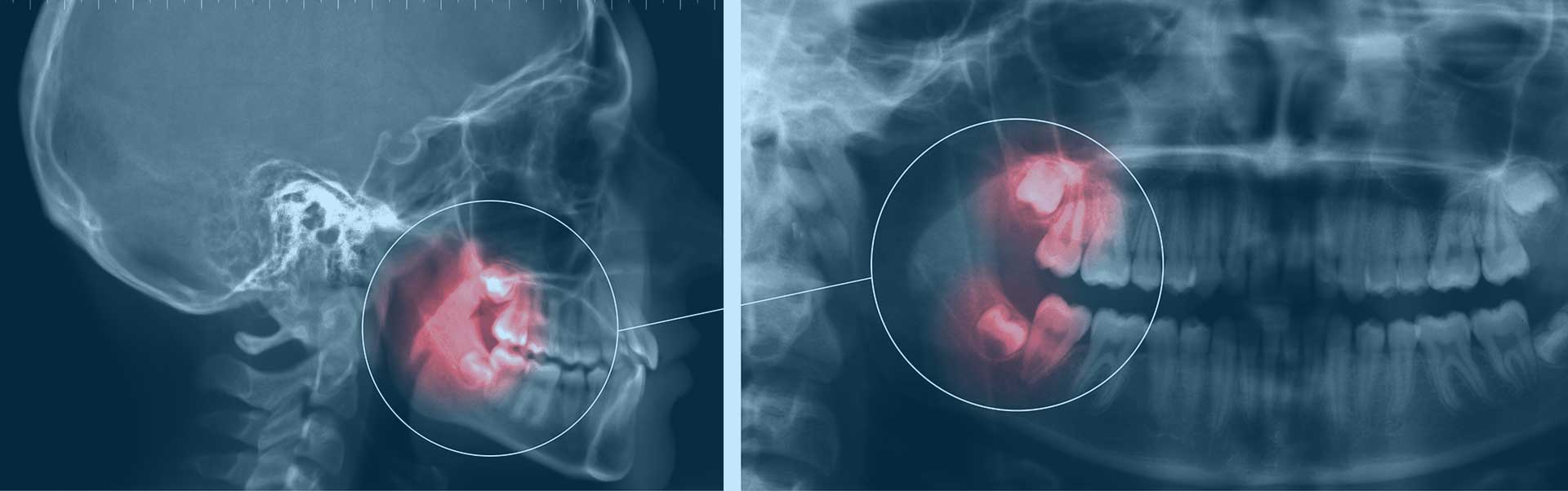Wisdom Tooth Extraction | Wentworth Family Dental | SW Calgary Dentist